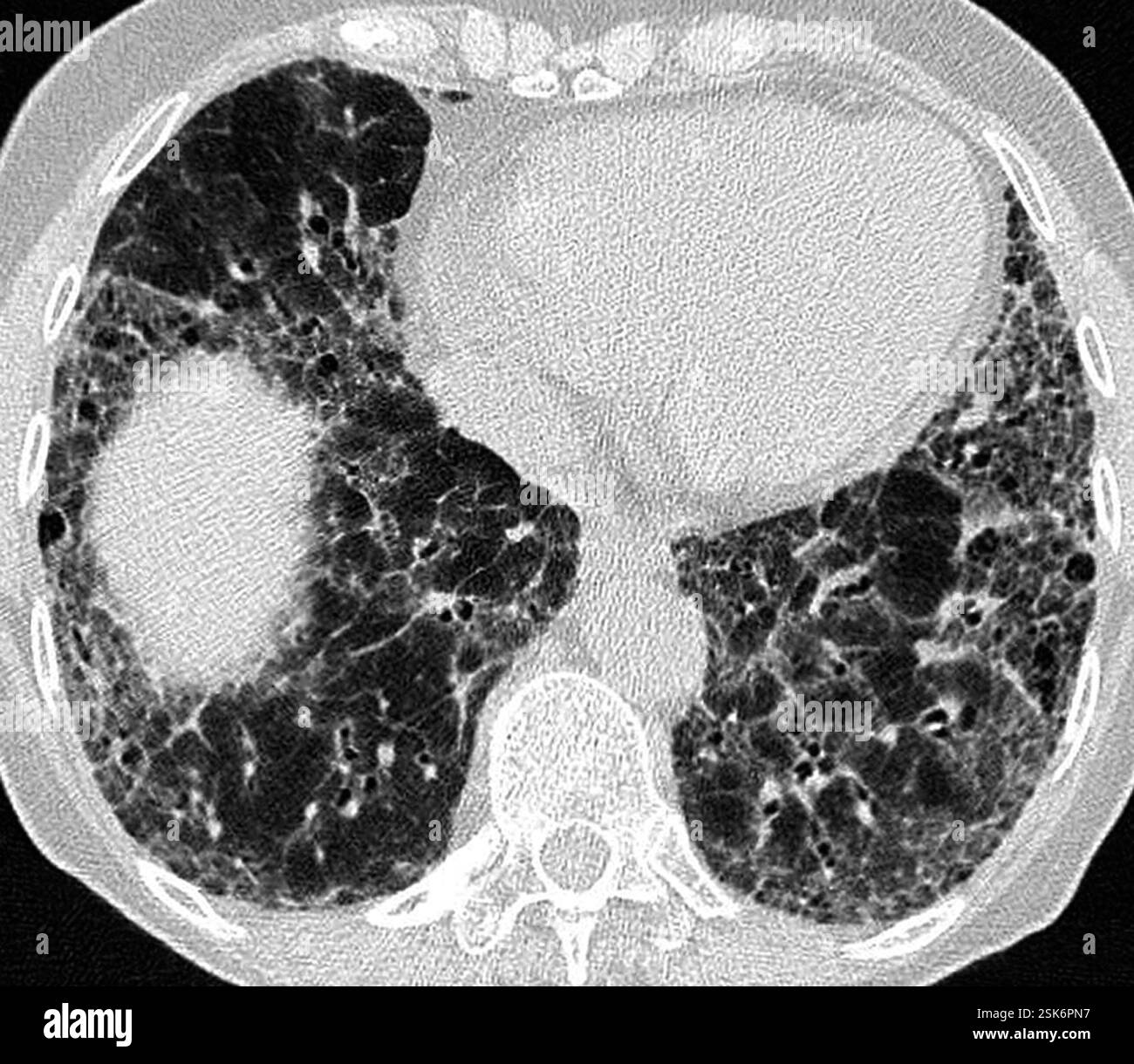 Non-infectious pneumonia. Computed tomography (CT) scan of an axial ...