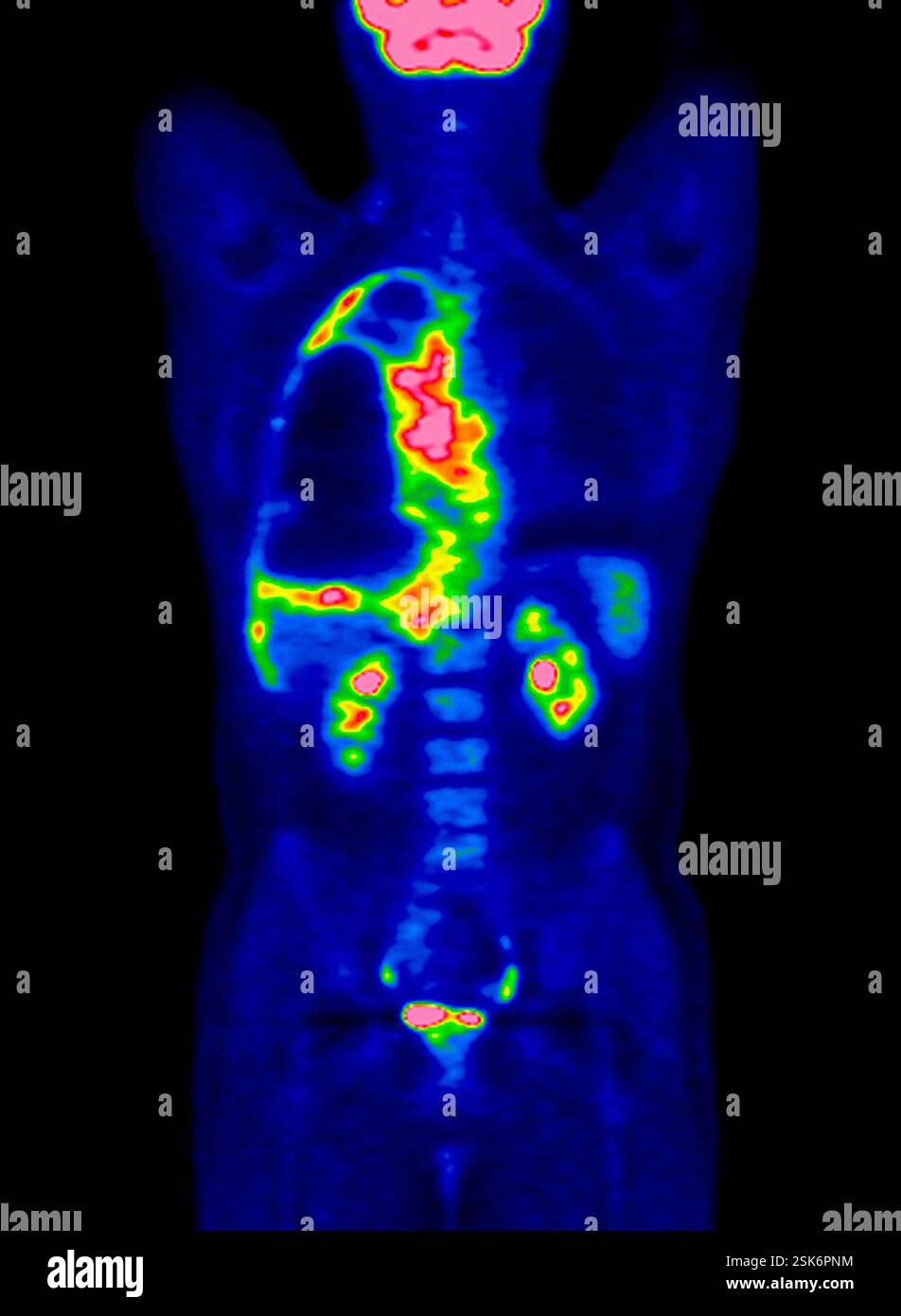 Mesothelioma lung cancer. Coloured positron emission tomography (PET) scan of the thorax and ...