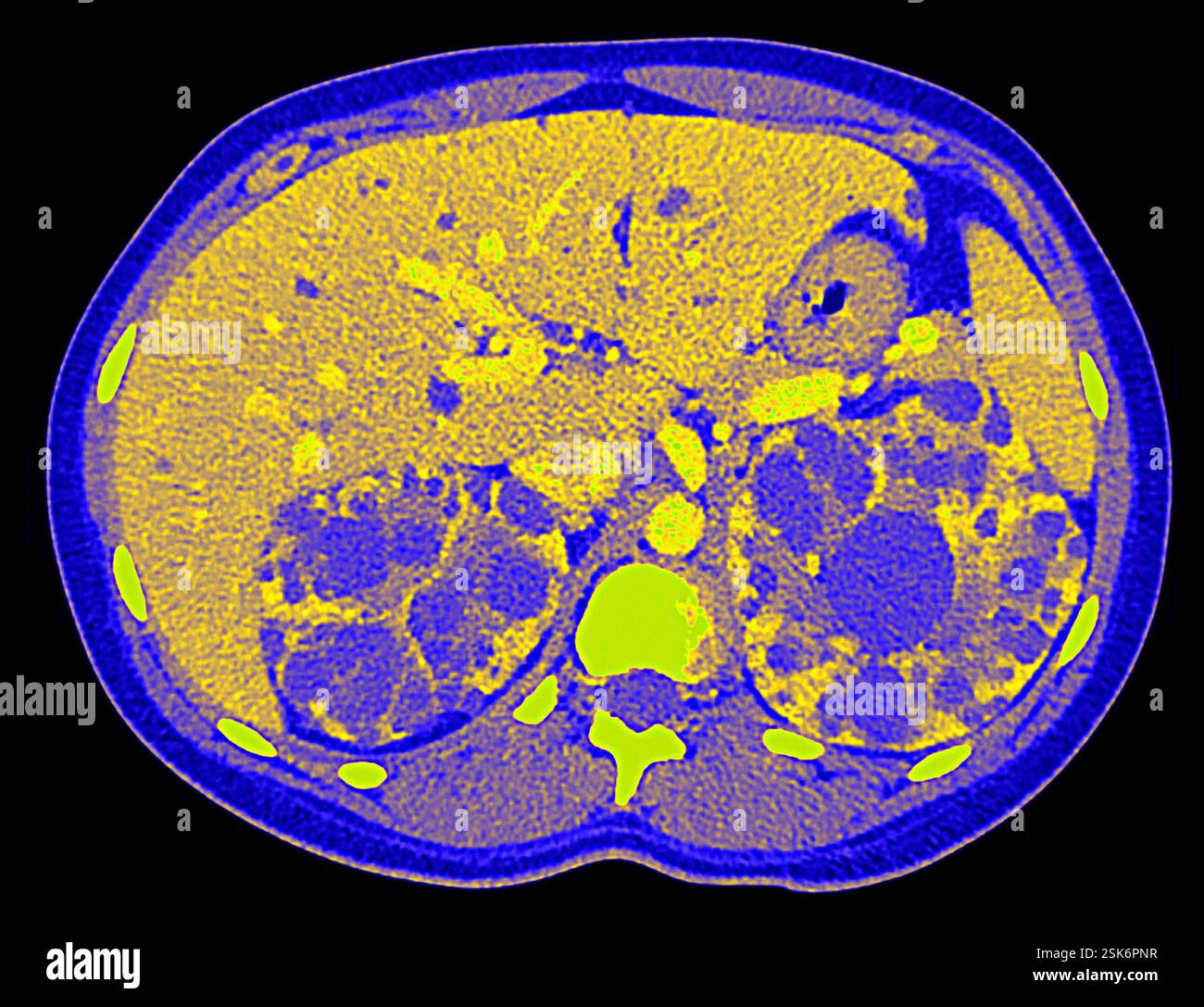 Polycystic kidneys. Coloured computed tomography (CT) scan of the abdomen of a 32-year-old ...