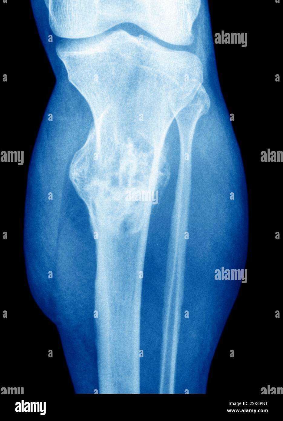 Bone tumour. Coloured frontal X-ray of the tibia (shin bone) of a ...