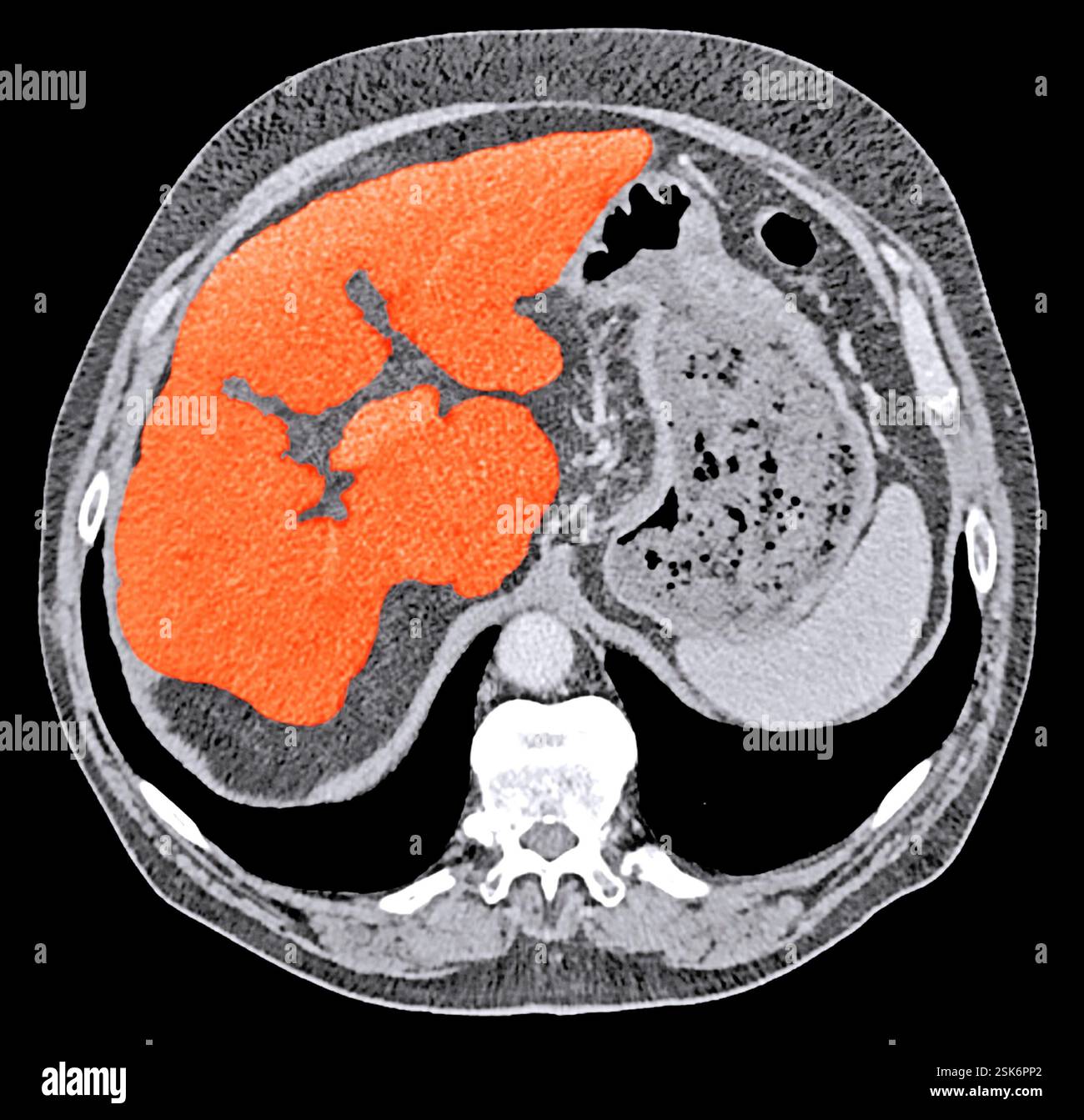 Liver cirrhosis. Coloured axial computed tomography (CT) scan of the ...