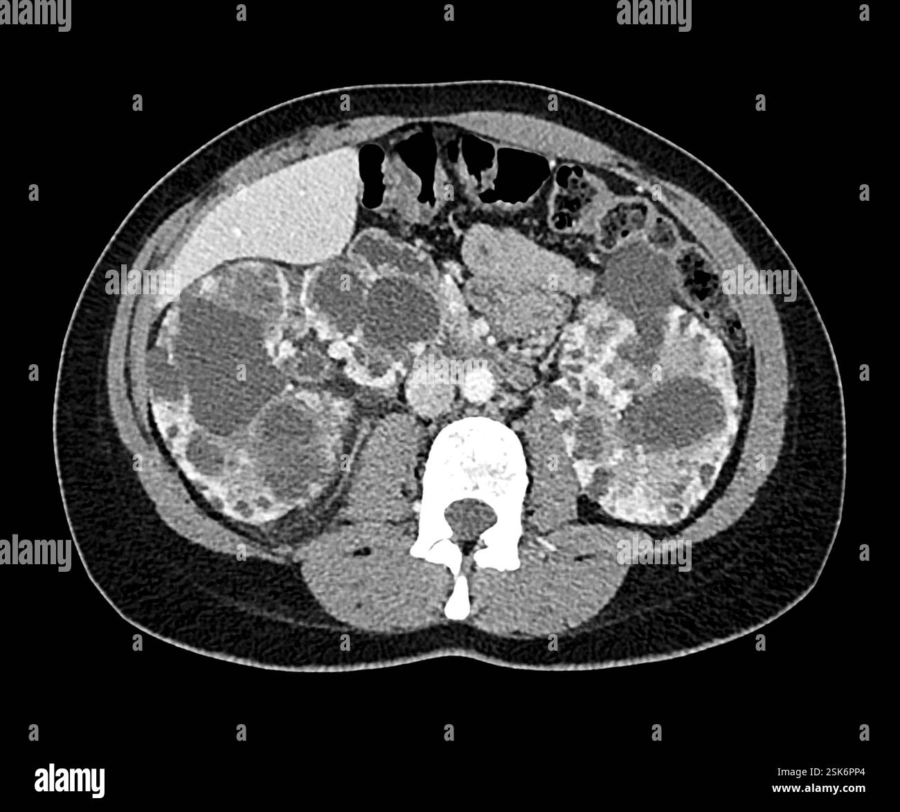 Polycystic kidneys. Computed tomography (CT) scan of the abdomen of a ...