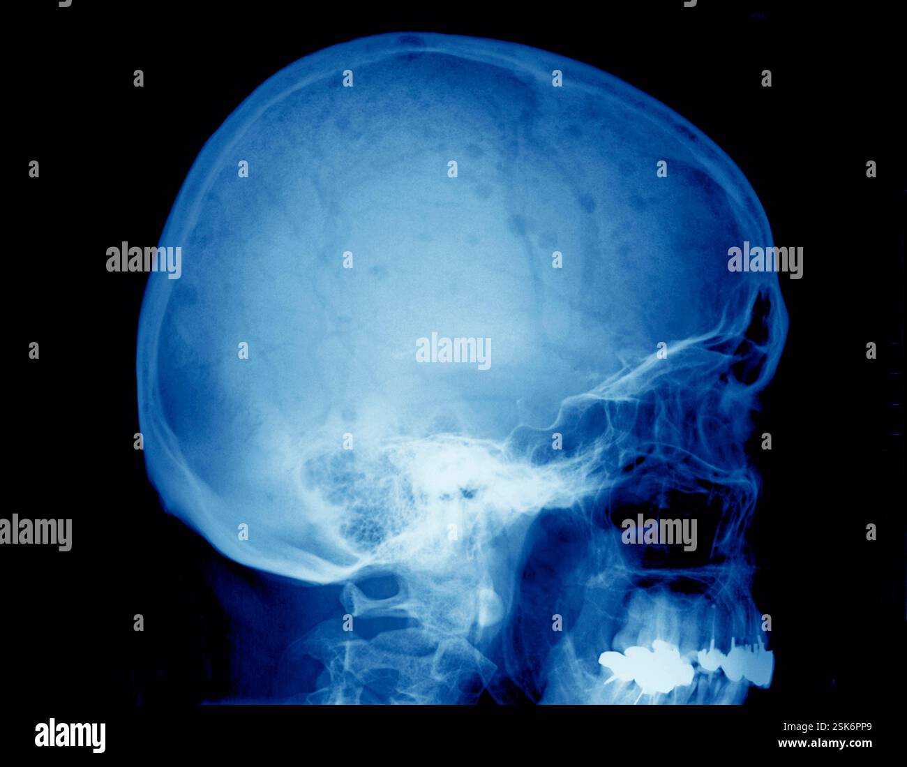 Cancer of the skull. Coloured X-ray of the skull of a person affected ...