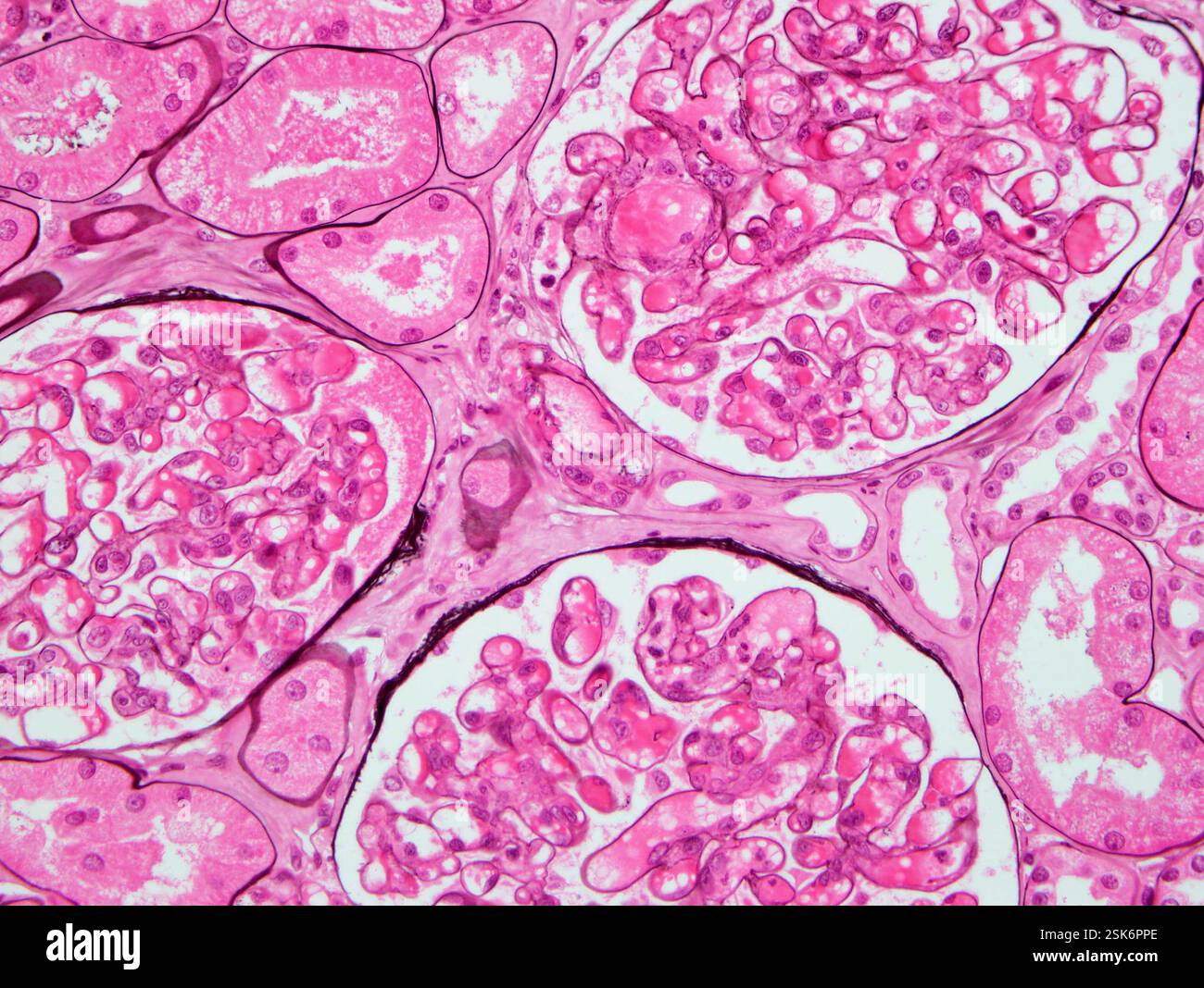 Glomerulonephritis. Light micrograph of a section through glomeruli in ...