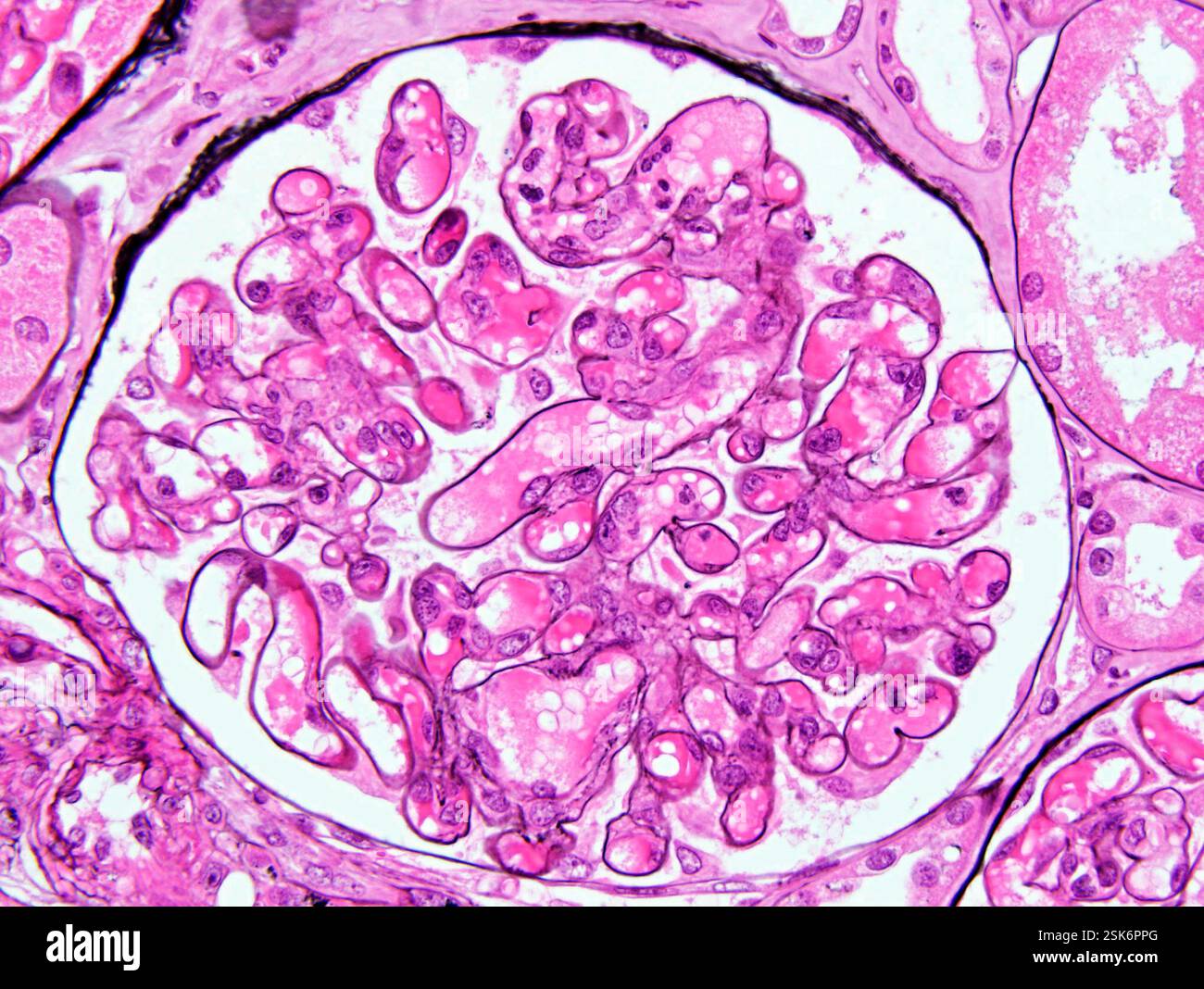Glomerulonephritis. Light micrograph of a section through a glomerulus ...