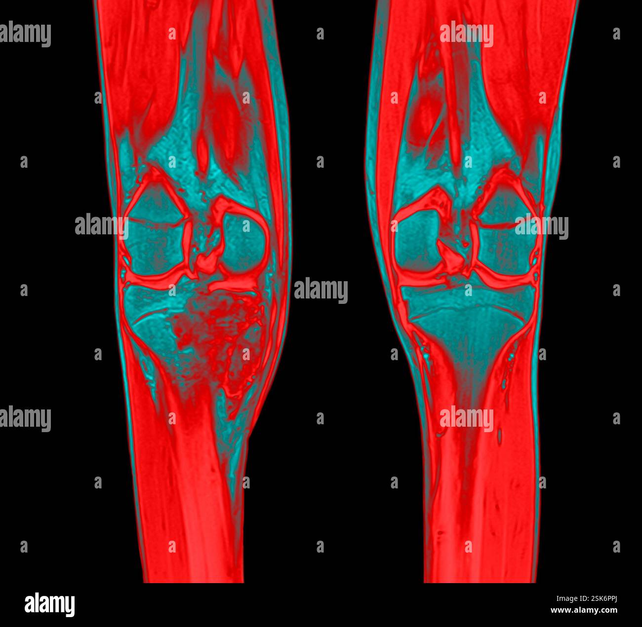 Bone cancer. Coloured magnetic resonance imaging (MRI) scan of the ...