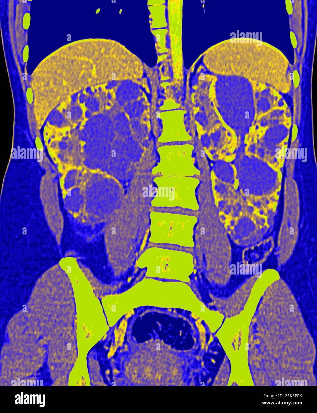 Polycystic kidneys. Coloured computed tomography (CT) scan of the abdomen of a 32-year-old ...