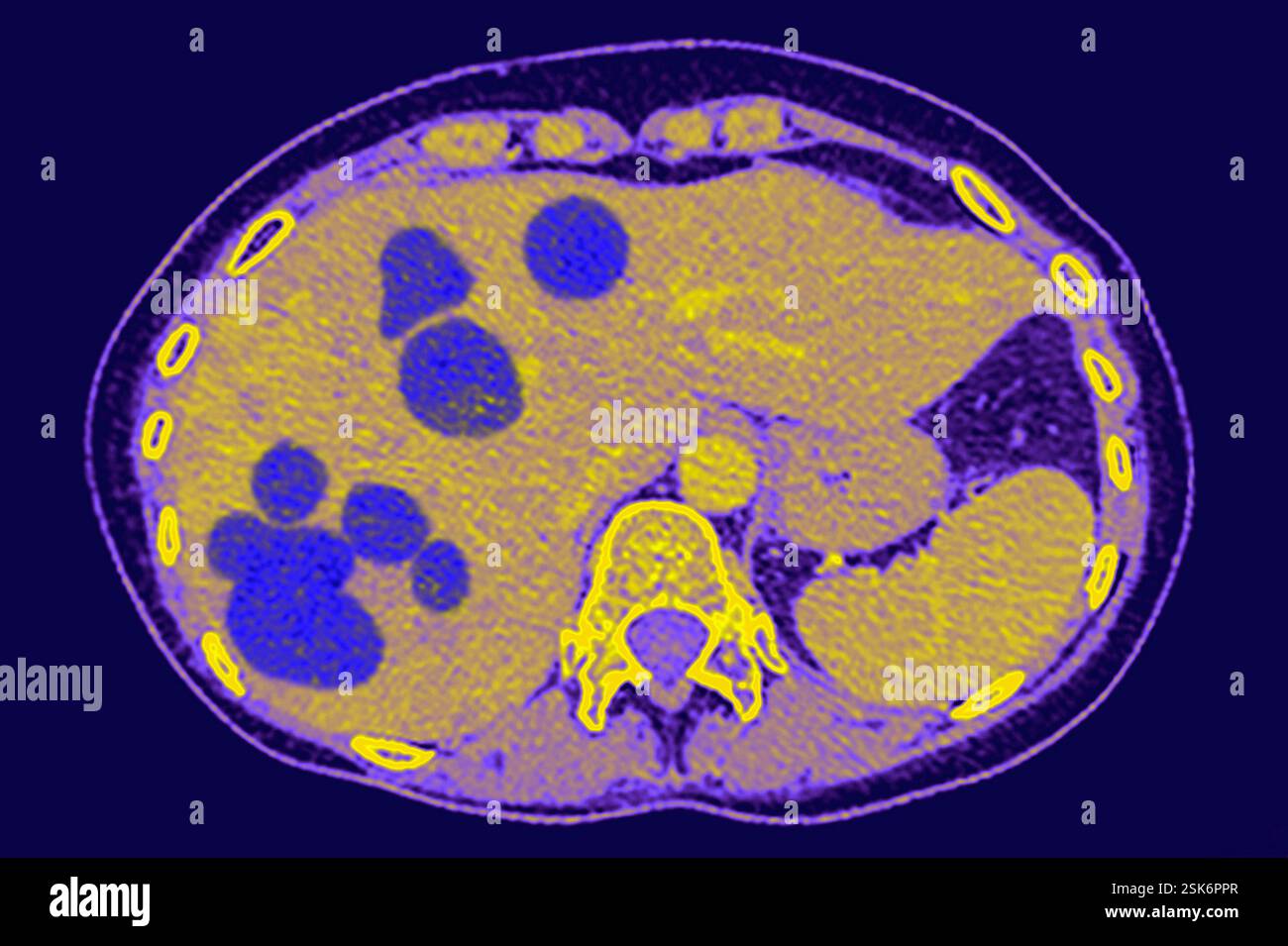 Secondary liver cancer. Coloured computed tomography (CT) scan of a section through the abdomen ...