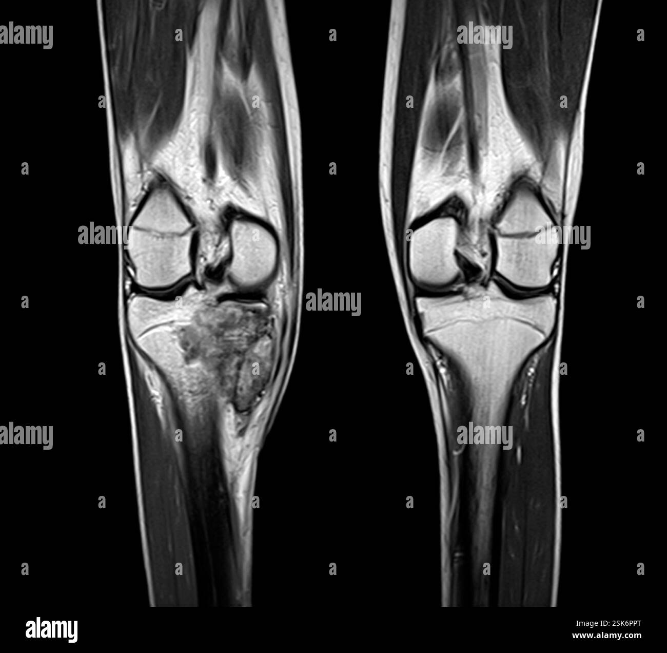 Bone cancer. Magnetic resonance imaging (MRI) scan of the knees of a ...