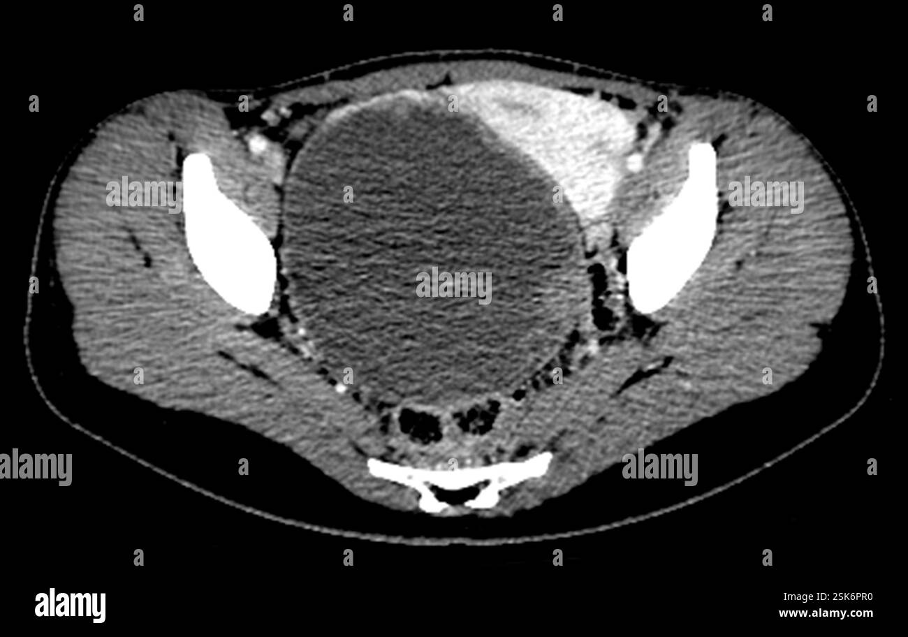Ovarian cancer. Computed tomography (CT) scan of a section through the ...
