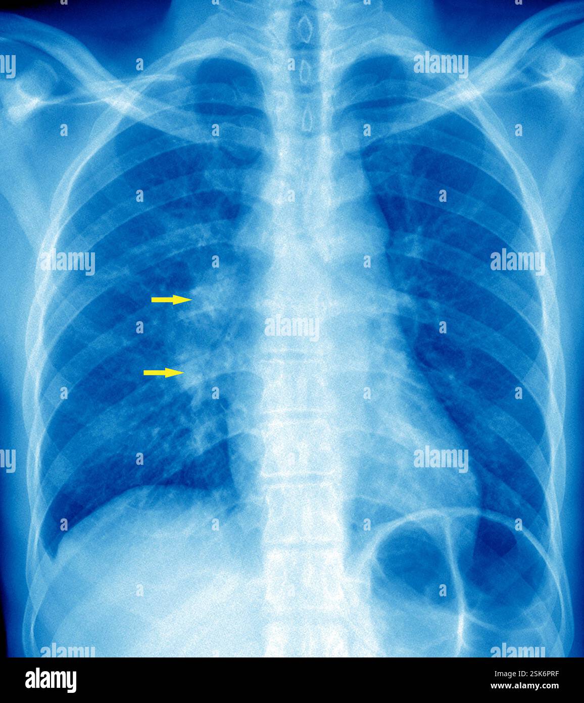 Lymph node tuberculosis. Coloured frontal chest X-ray of a 27-year-old ...