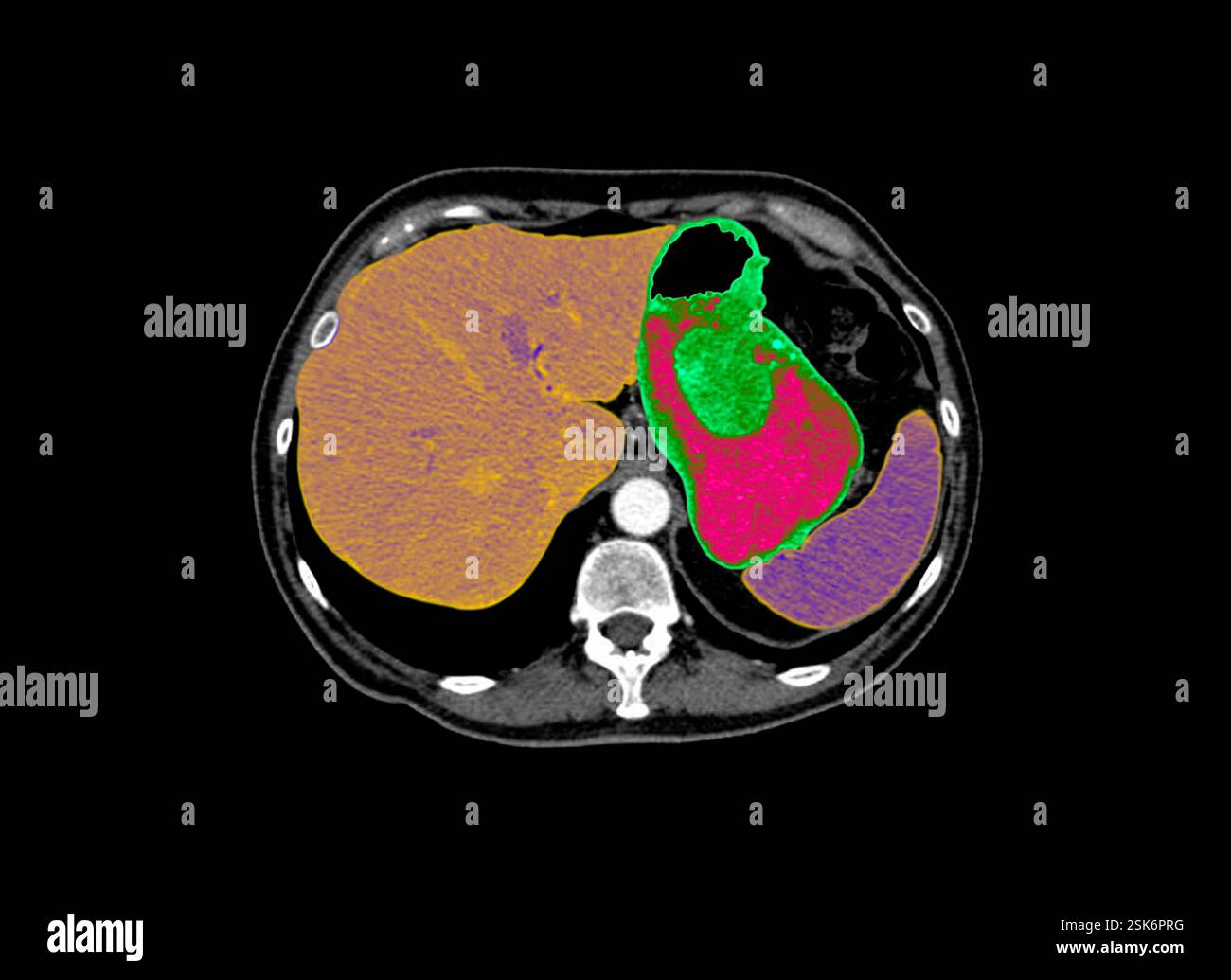 Stomach cancer. Coloured computed tomography (CT) scan of an axial section through a patient's ...