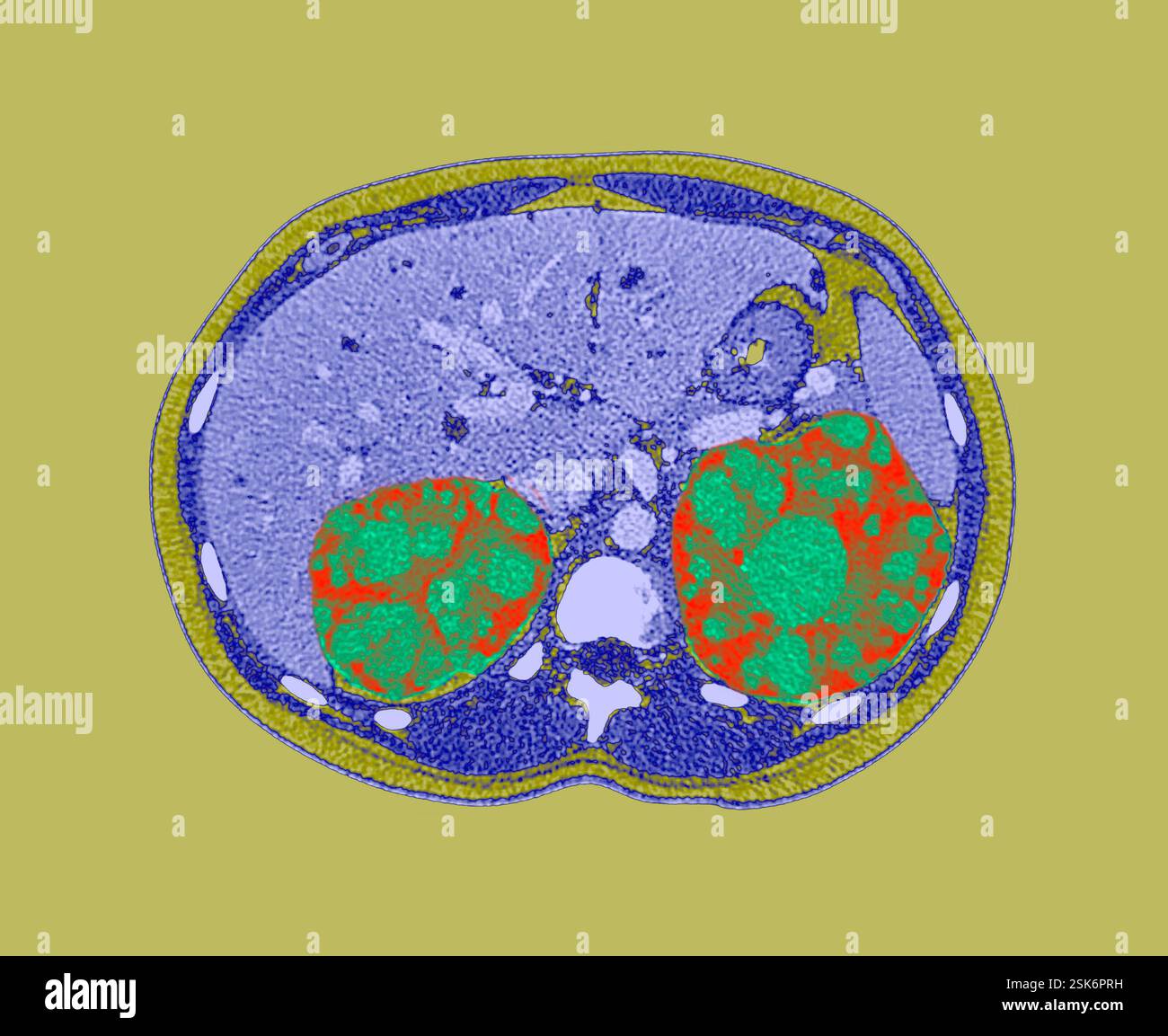Polycystic kidneys. Coloured computed tomography (CT) scan of an axial ...