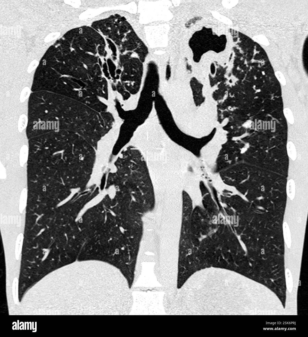 Tuberculosis of the lung. Frontal computed tomography (CT) scan of a 43 ...