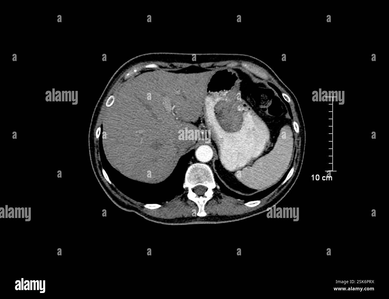 Stomach cancer. Computed tomography (CT) scan of an axial section through a patient's abdomen ...