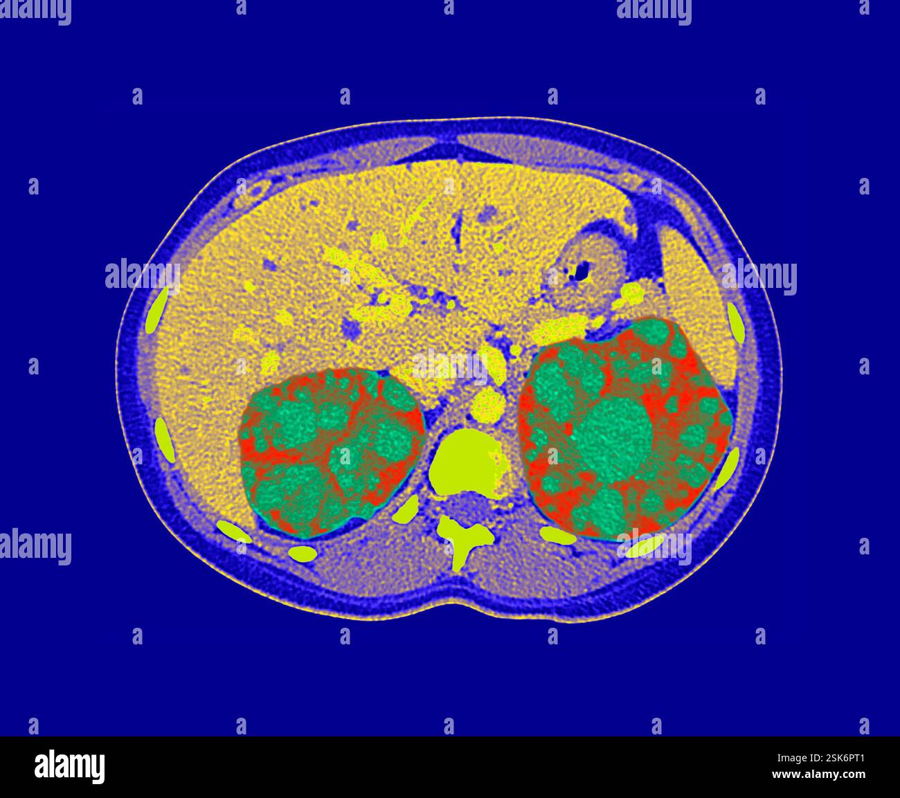Polycystic kidneys. Coloured computed tomography (CT) scan of an axial section through the ...