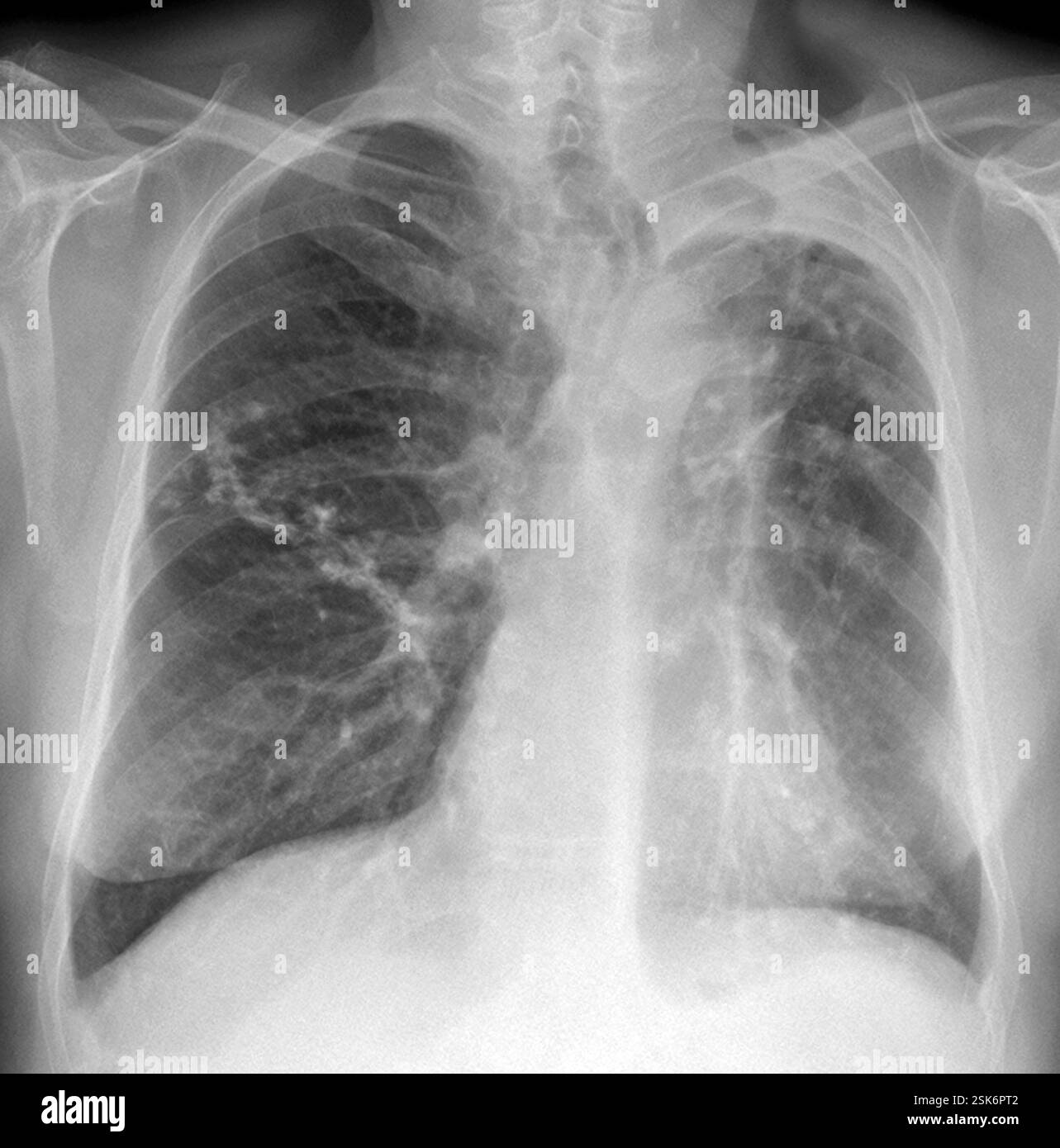 Tuberculosis of the lung. Frontal chest X-ray of a 53-year-old male ...