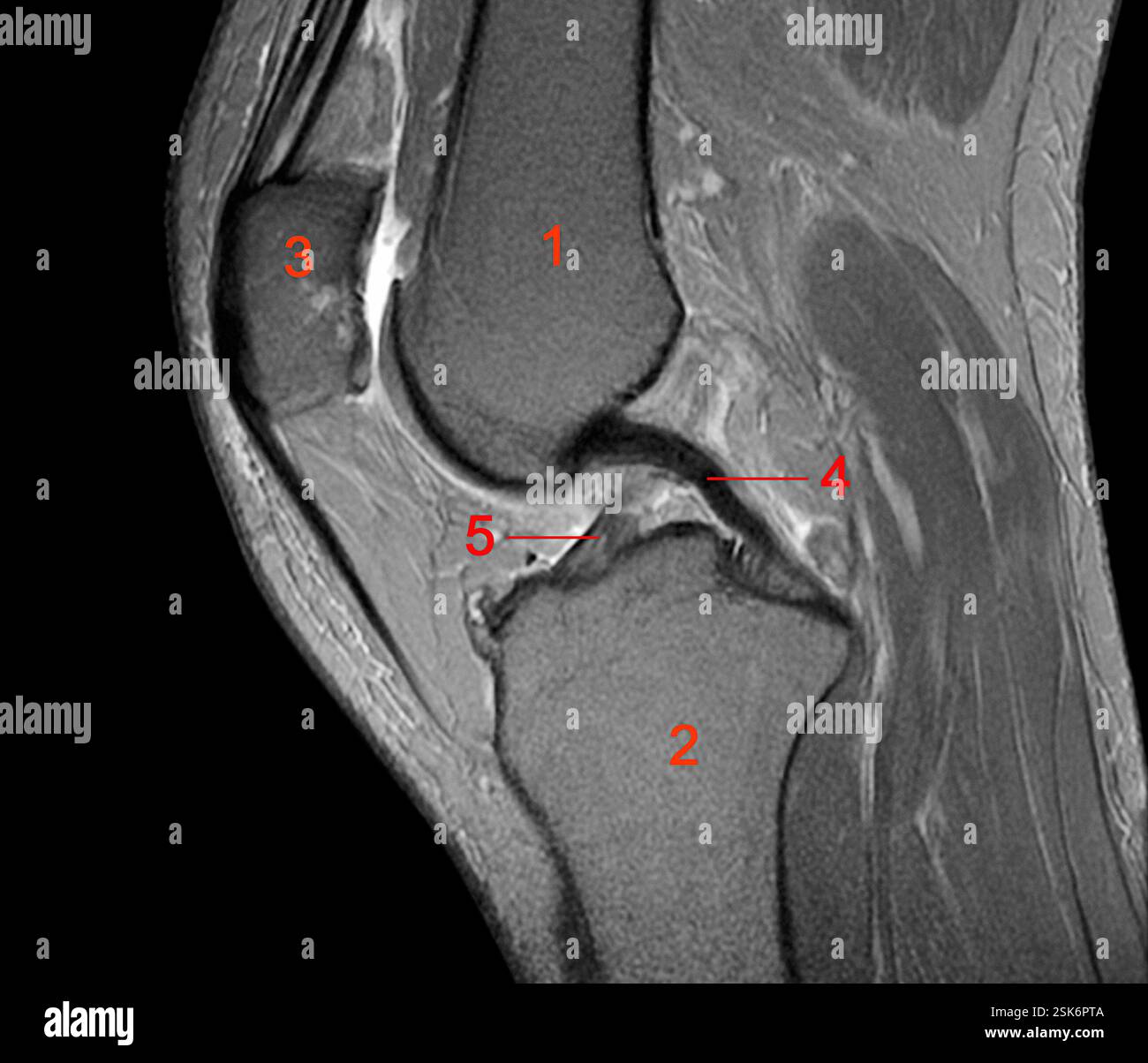 Normal knee. Magnetic resonance imaging (MRI) scan of a section through a healthy human knee ...
