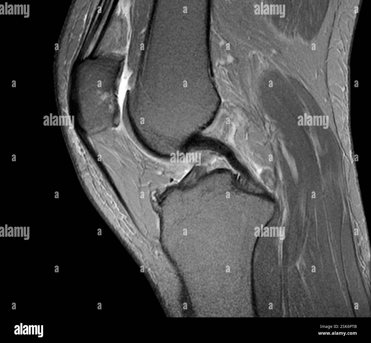 Normal knee. Magnetic resonance imaging (MRI) scan of a section through a healthy human knee ...