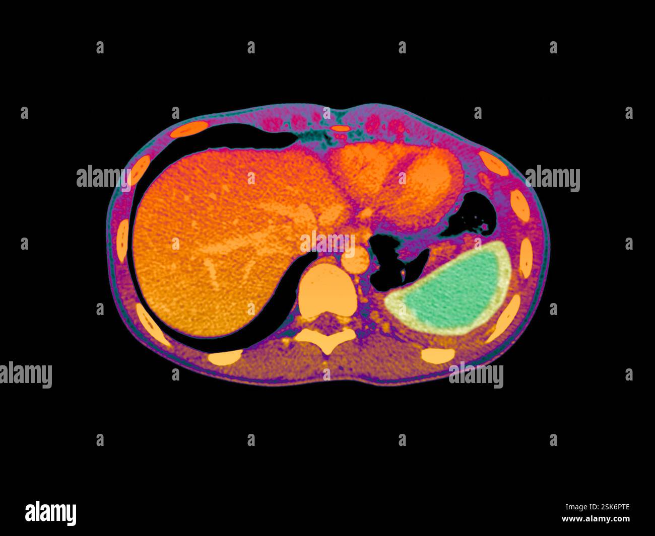Pleural tuberculosis. Coloured computed tomography (CT) scan of an axial section through the ...