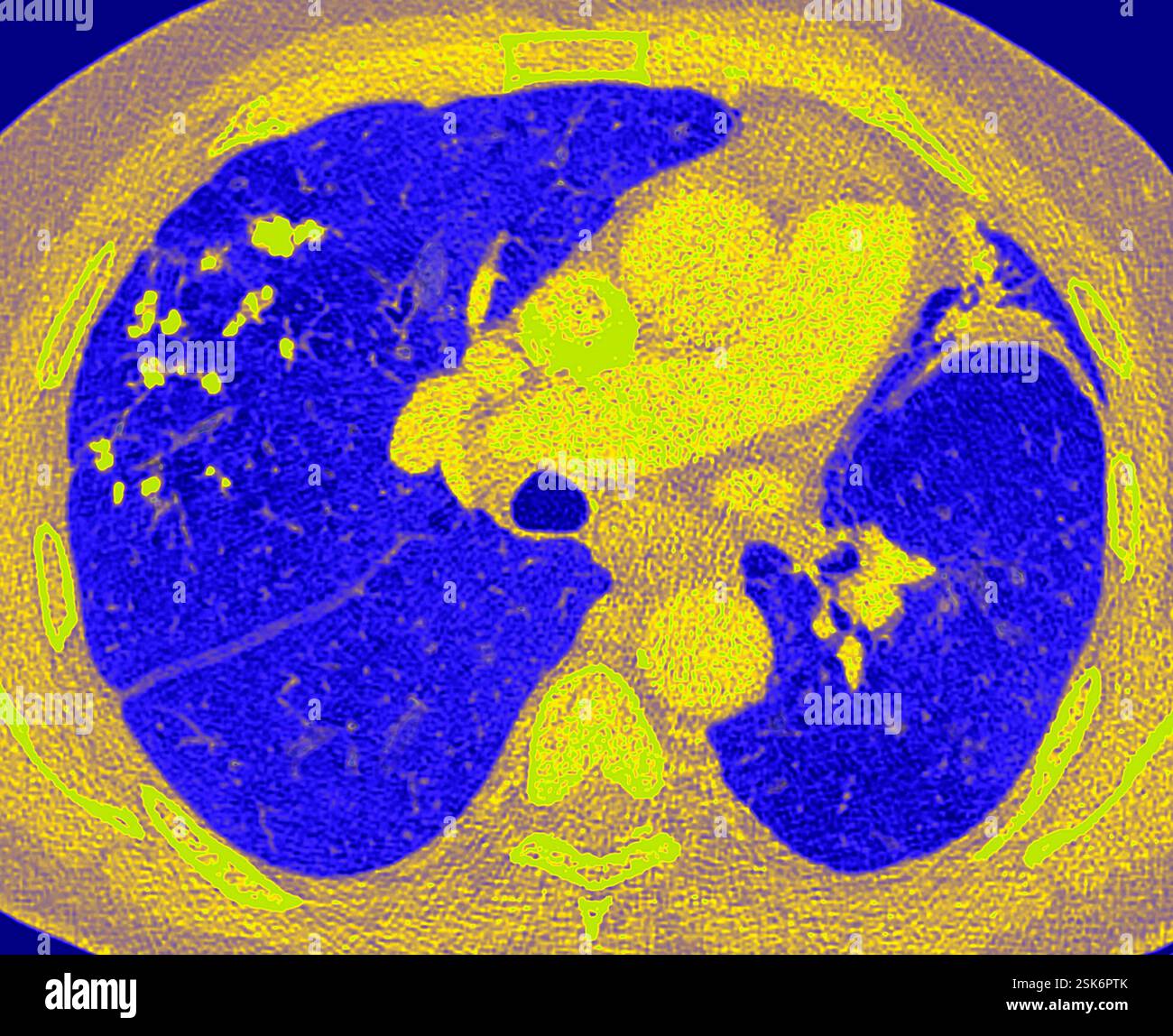 Tuberculosis of the lung. Coloured computed tomography (CT) scan of an axial section through the ...