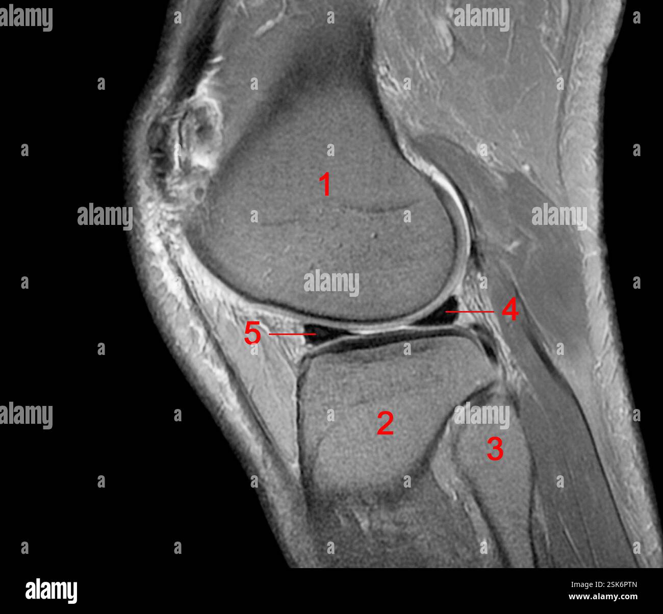 Normal knee. Magnetic resonance imaging (MRI) scan of a section through ...