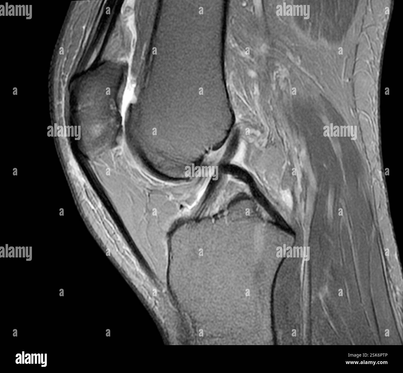 Normal knee. Magnetic resonance imaging (MRI) scan of a section through ...