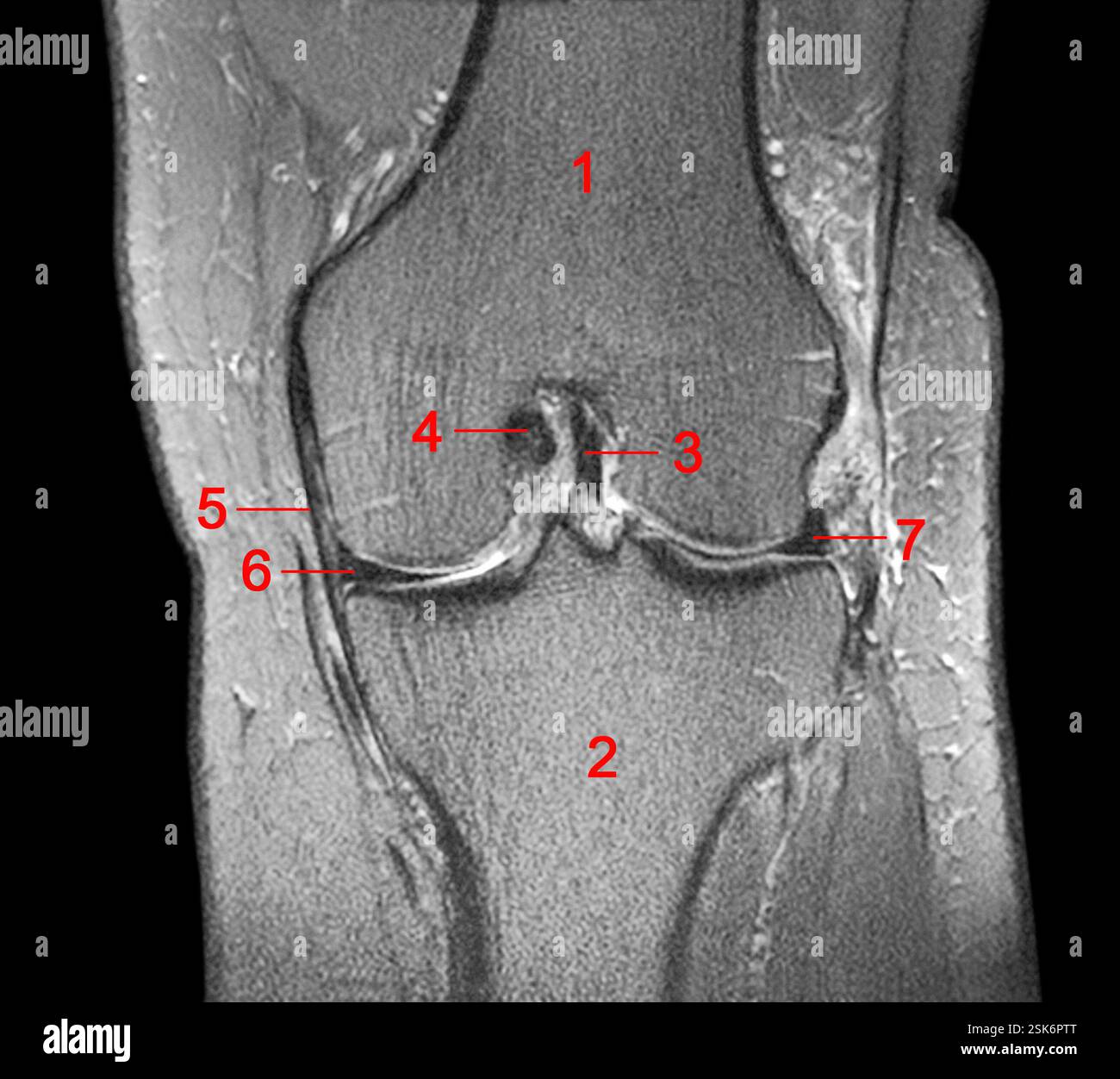Normal knee. Magnetic resonance imaging (MRI) scan of a section through ...