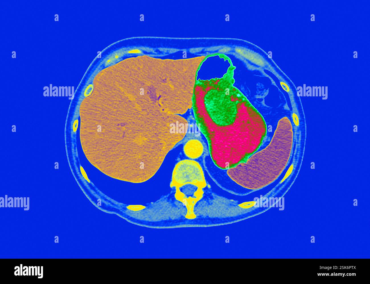 Stomach cancer. Coloured computed tomography (CT) scan of an axial section through a patient's ...