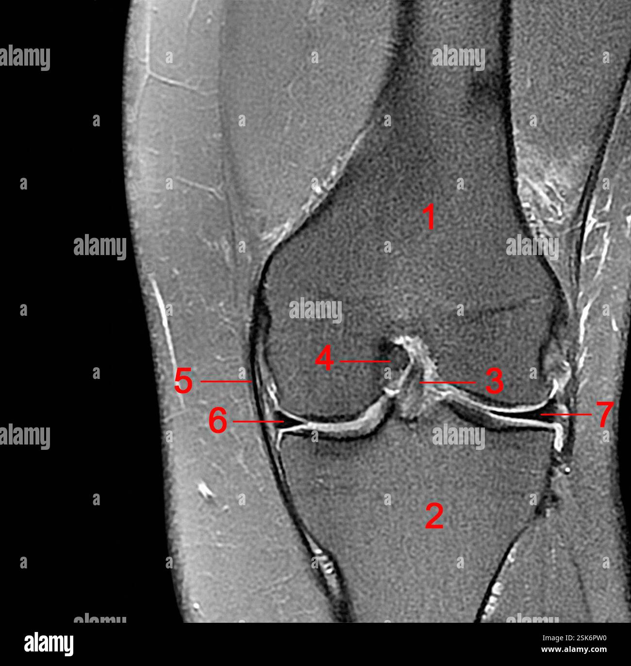 Normal knee. Magnetic resonance imaging (MRI) scan of a section through a healthy human knee ...