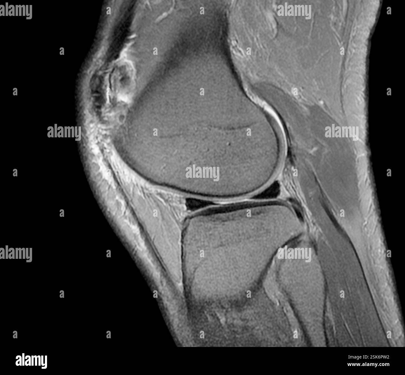 Normal knee. Magnetic resonance imaging (MRI) scan of a section through ...