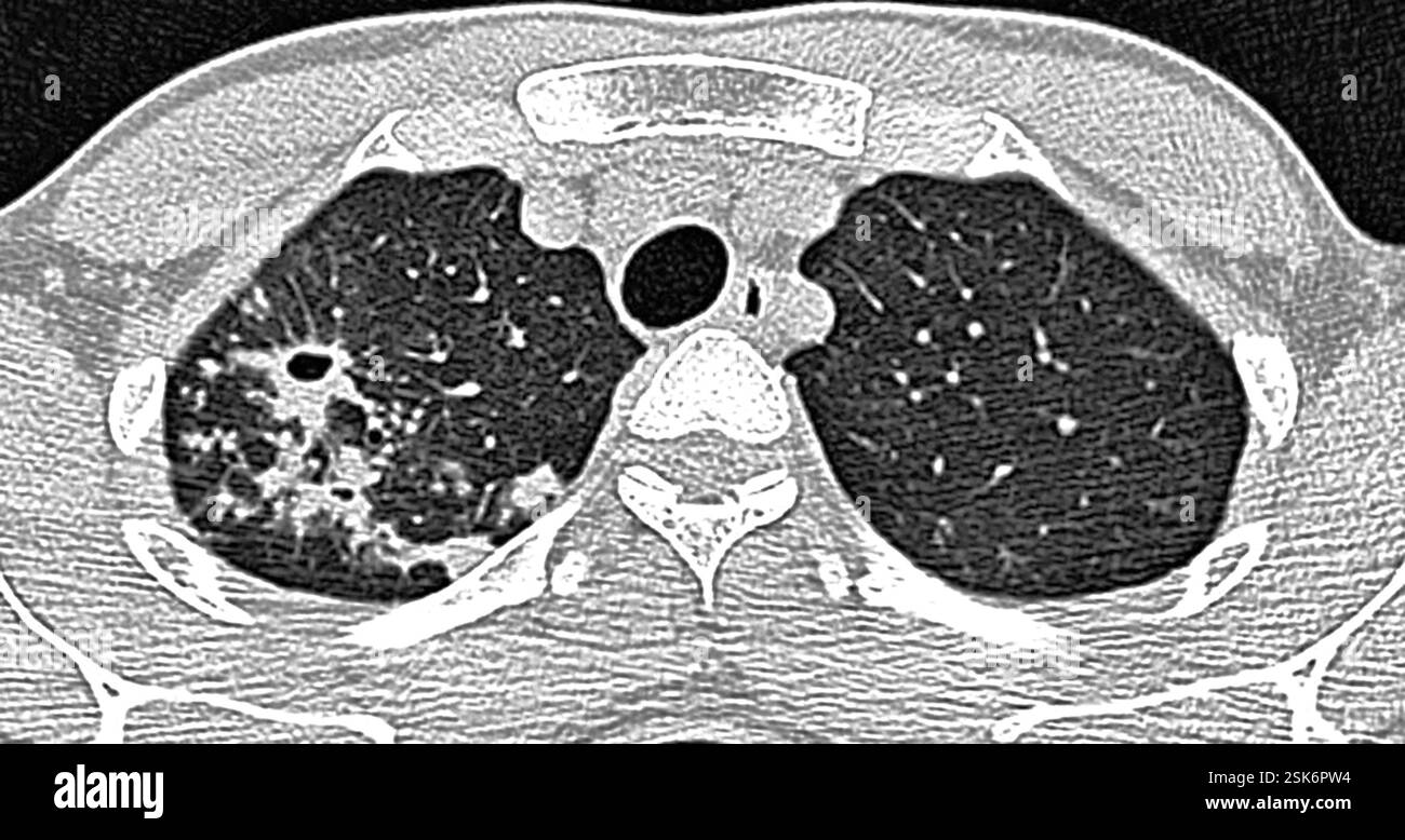 Tuberculosis of the lung. Computed tomography (CT) scan of an axial section through the chest of ...