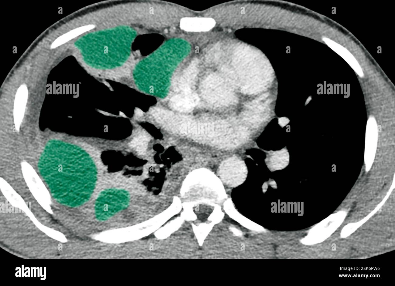 Pleurisy. Coloured computed tomography (CT) scan of an axial section ...