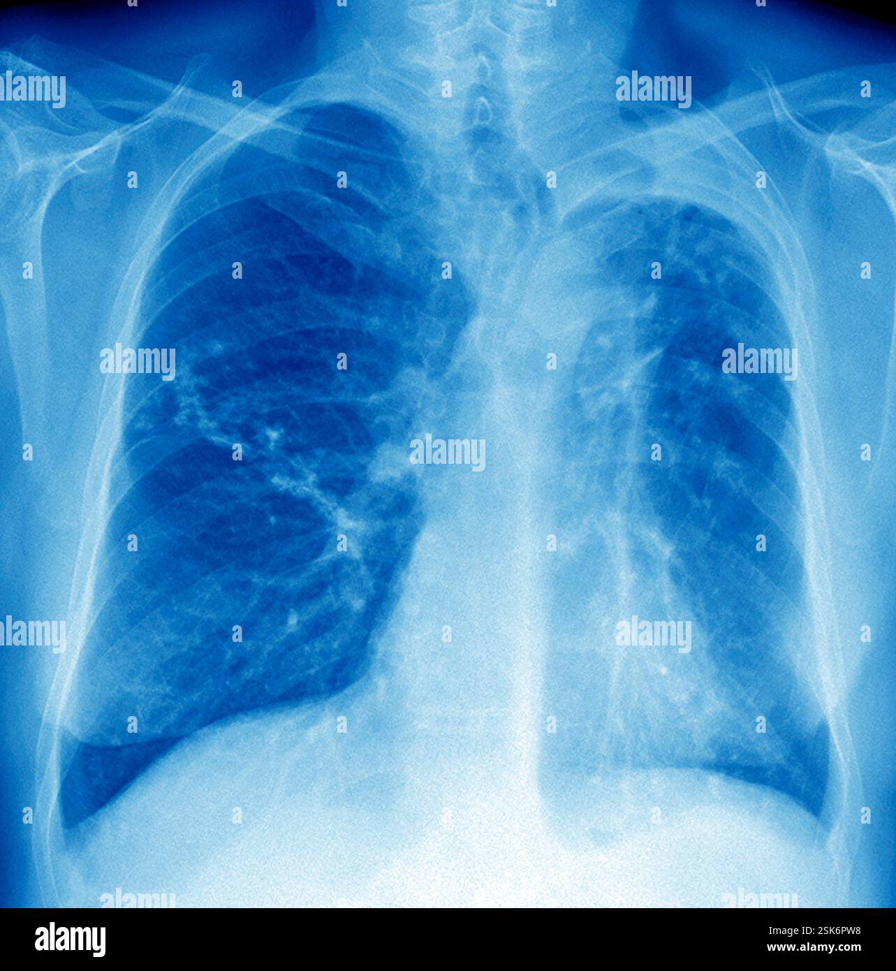 Tuberculosis of the lung. Coloured frontal chest X-ray of a 53-year-old ...