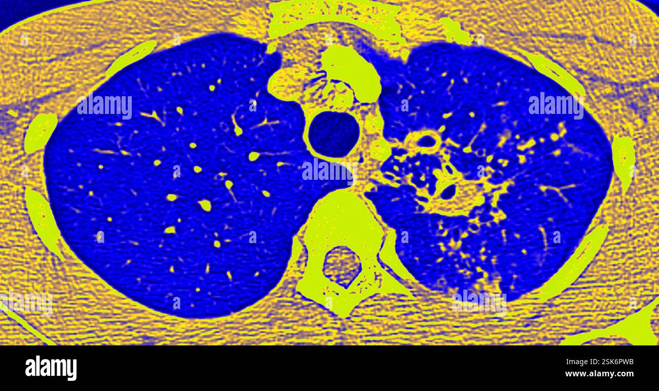 Tuberculosis of the lung. Coloured computed tomography (CT) scan of an axial section through the ...