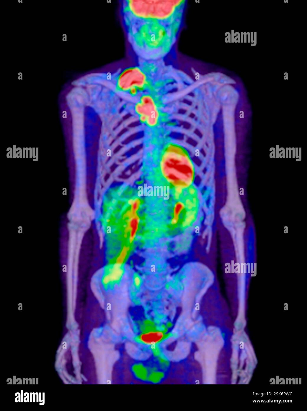 Lung cancer. Coloured combined frontal positron emission tomography (PET) and 3D computed ...