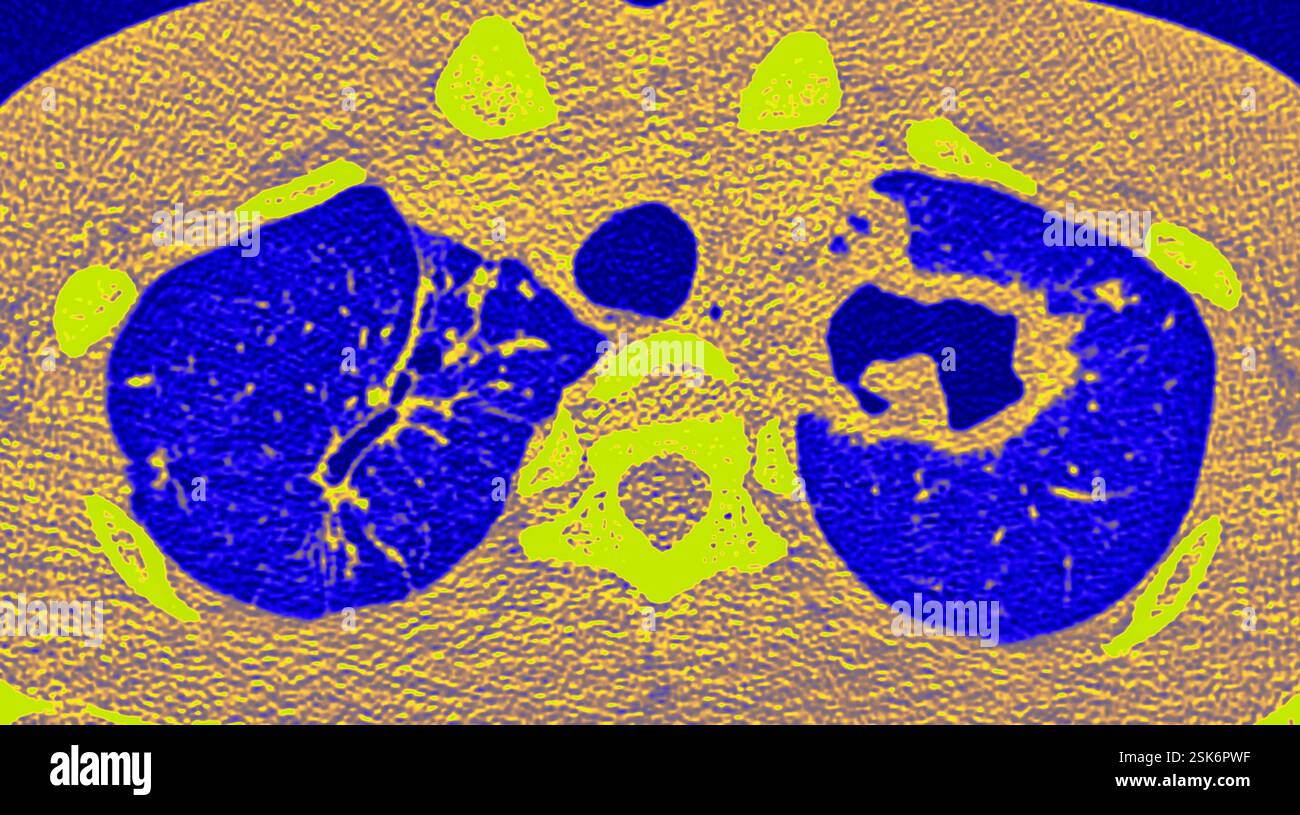Tuberculosis of the lung. Coloured computed tomography (CT) scan of an axial section through the ...