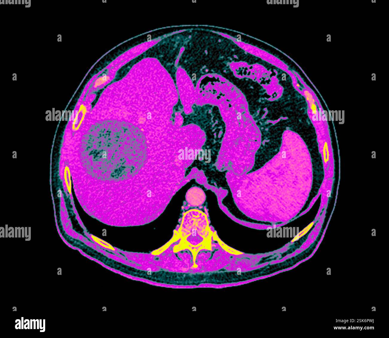 Liver cancer. Coloured computed tomography (CT) scan of an axial section through the abdomen of ...
