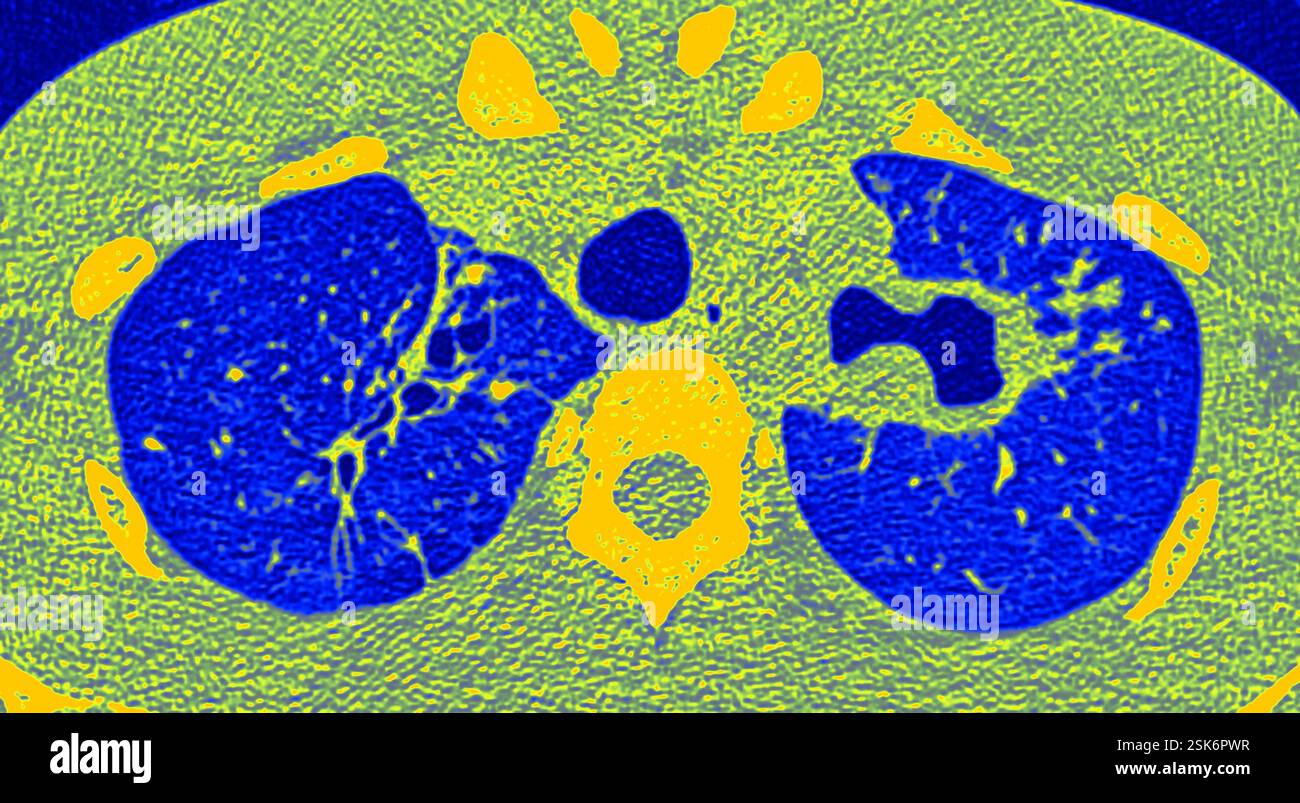 Tuberculosis of the lung. Coloured computed tomography (CT) scan of an axial section through the ...