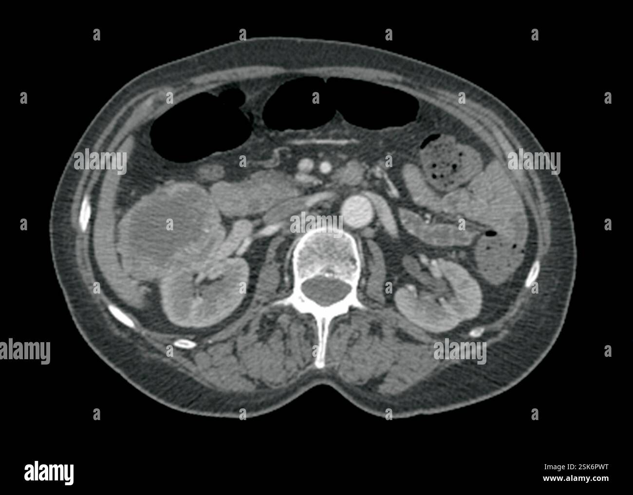 Kidney cancer. Computed tomography (CT) scan of an axial section ...