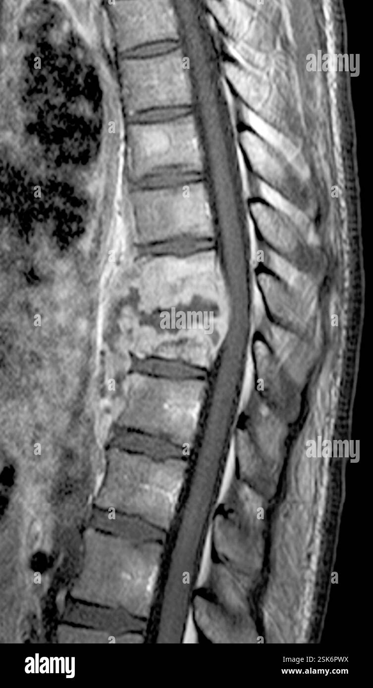 Tuberculosis spondylitis. Magnetic resonance imaging (MRI) scan of a ...