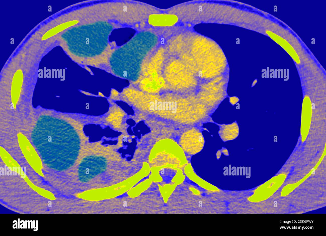 Pleurisy. Coloured computed tomography (CT) scan of an axial section ...