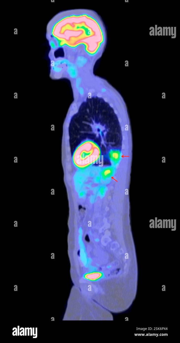 Lung cancer. Coloured combined positron emission tomography (PET) and computed tomography (CT ...