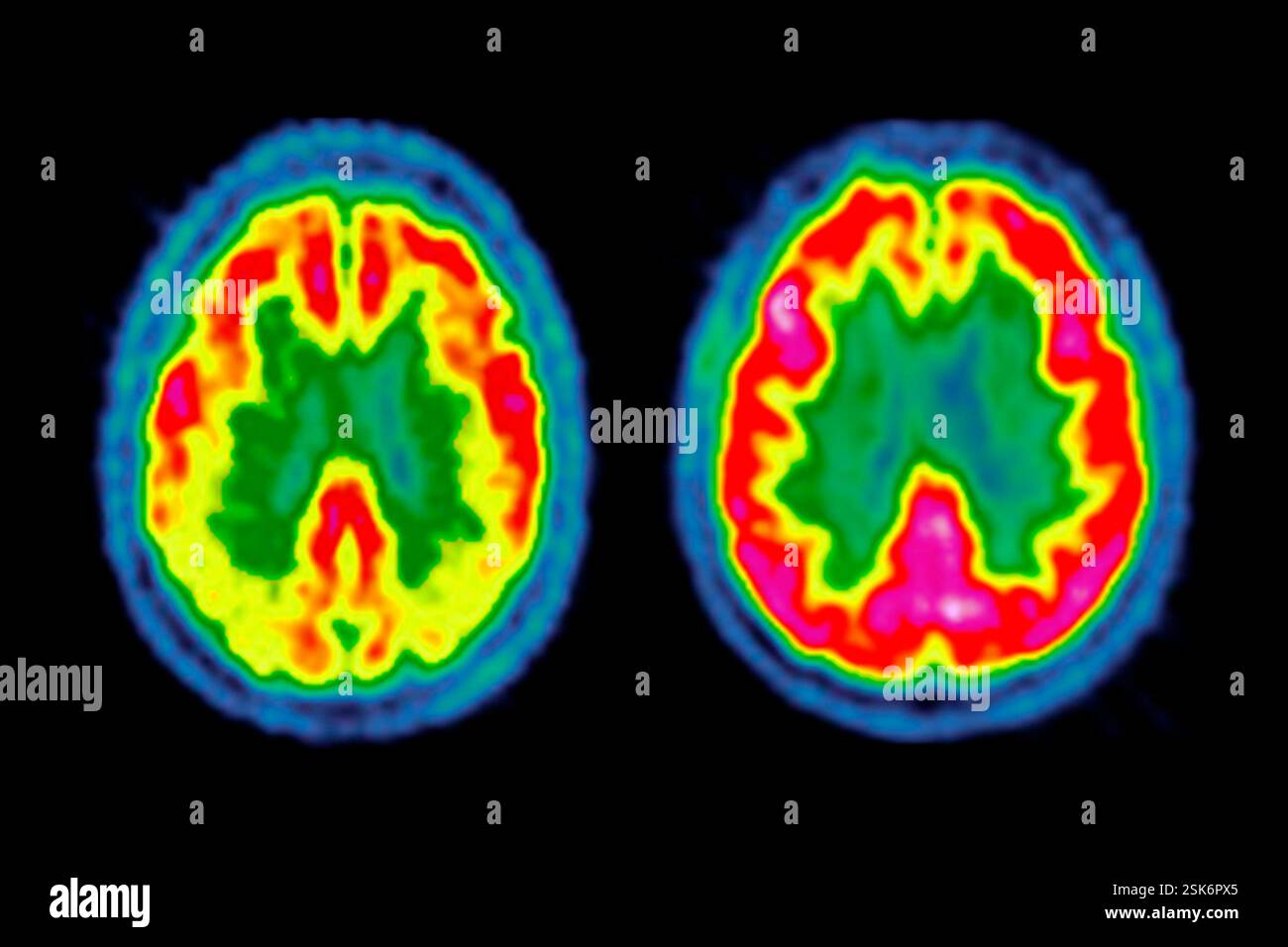 Brain activity in Lewy body dementia. Coloured positron emission ...
