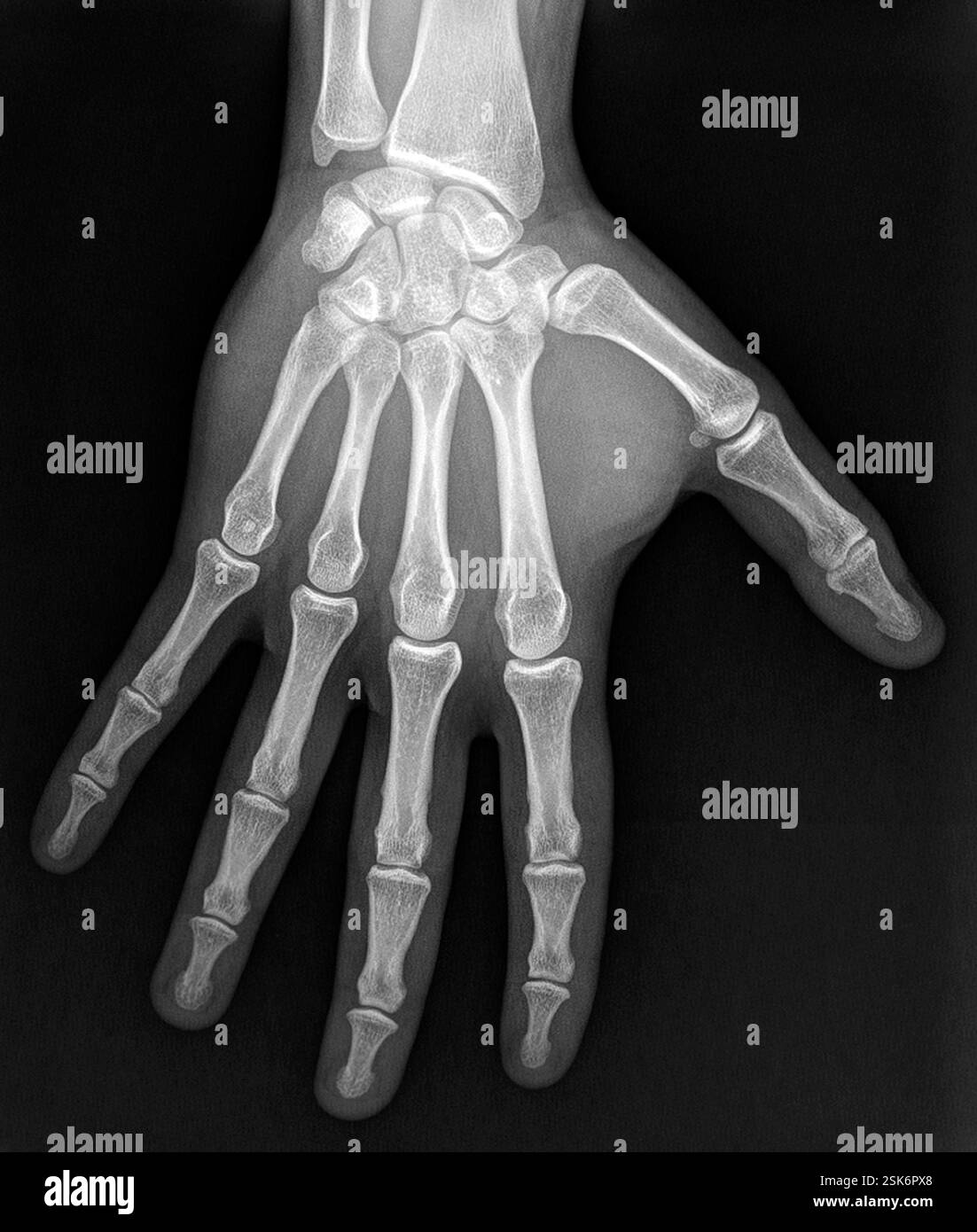 Normal hand. X-ray of the healthy right hand of a 30-year-old woman ...