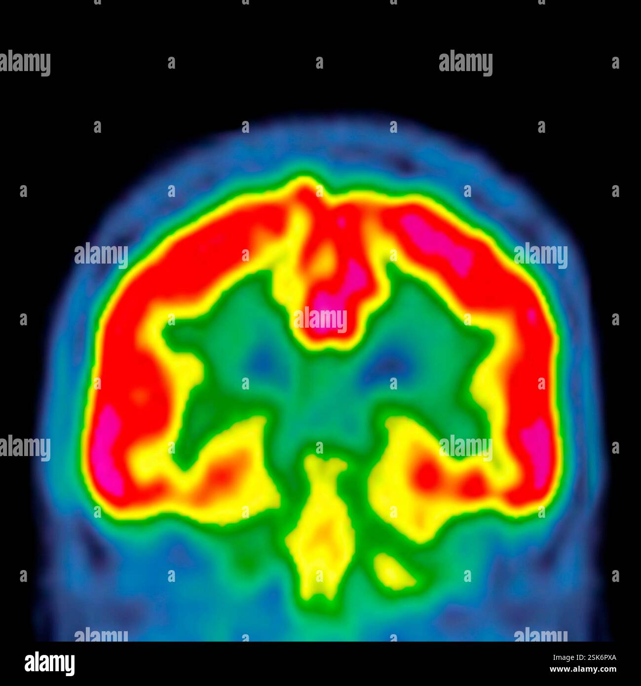 Normal brain activity. Coloured positron emission tomography (PET) scan ...