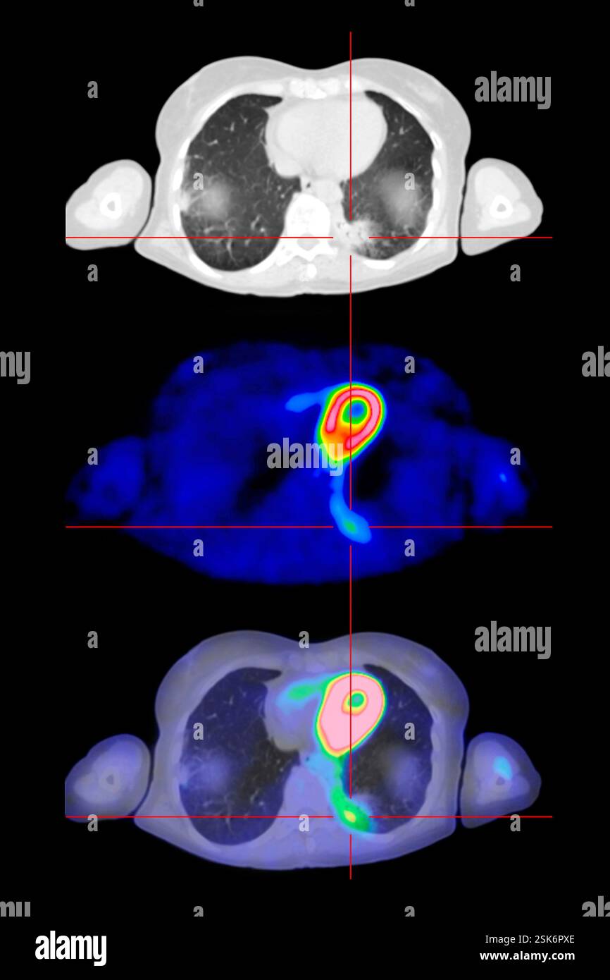 Lung cancer. Coloured combined positron emission tomography (PET) and computed tomography (CT ...