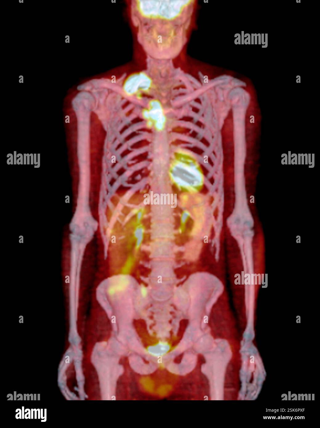 Lung cancer. Coloured combined frontal positron emission tomography (PET) and 3D computed ...