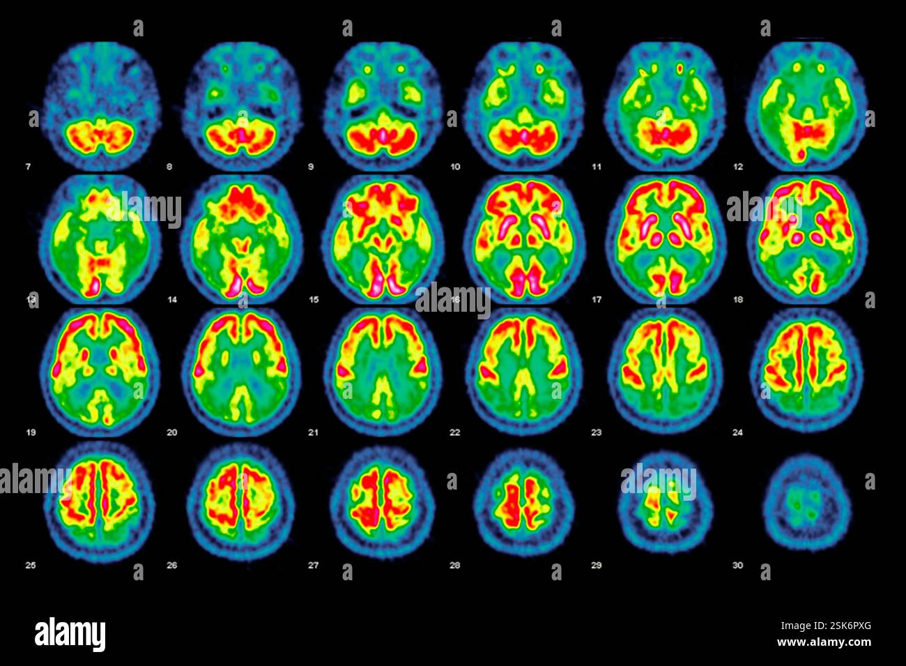 Brain activity in Benson's syndrome. Coloured positron emission ...