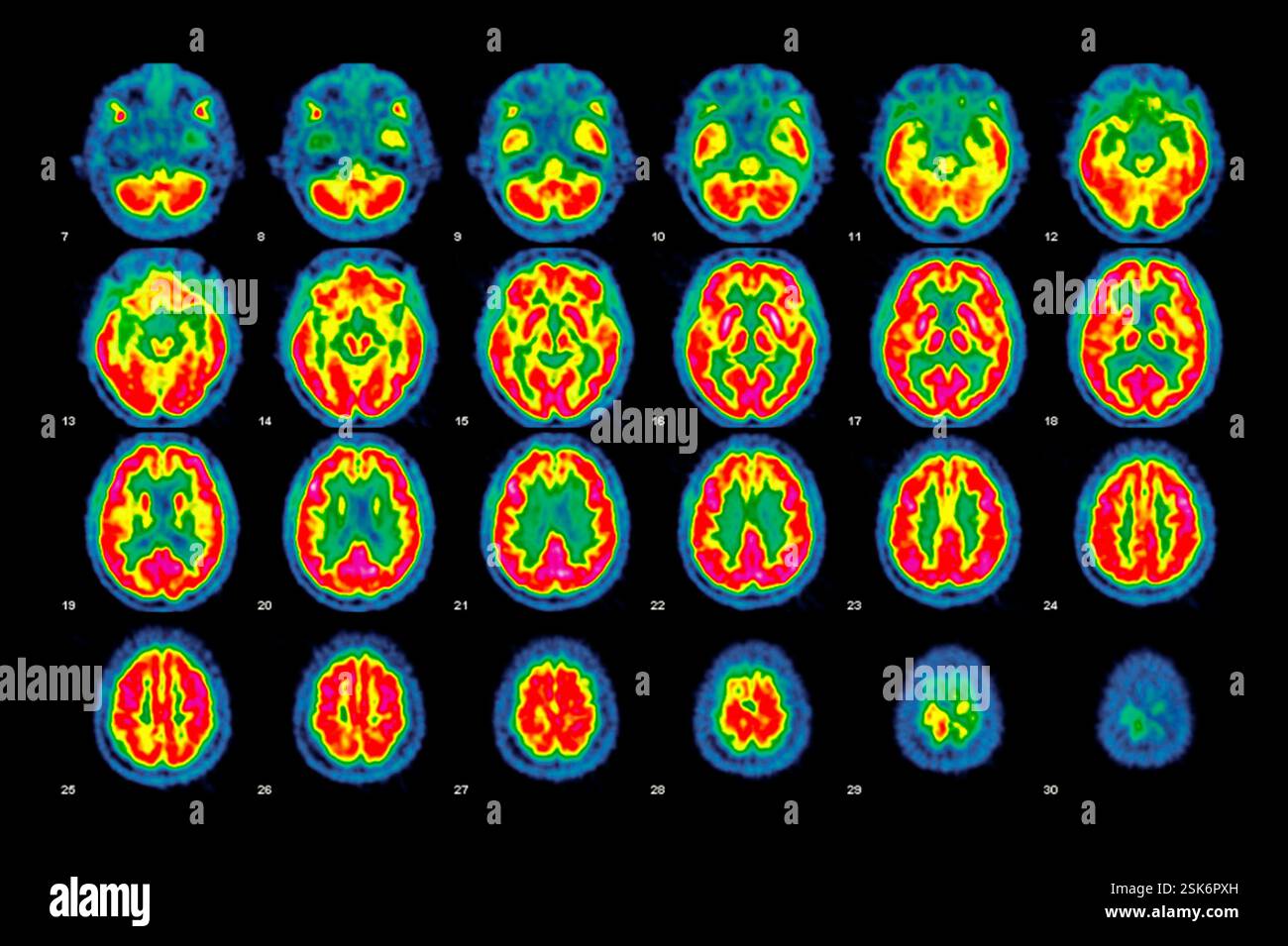 Normal brain activity. Coloured positron emission tomography (PET ...